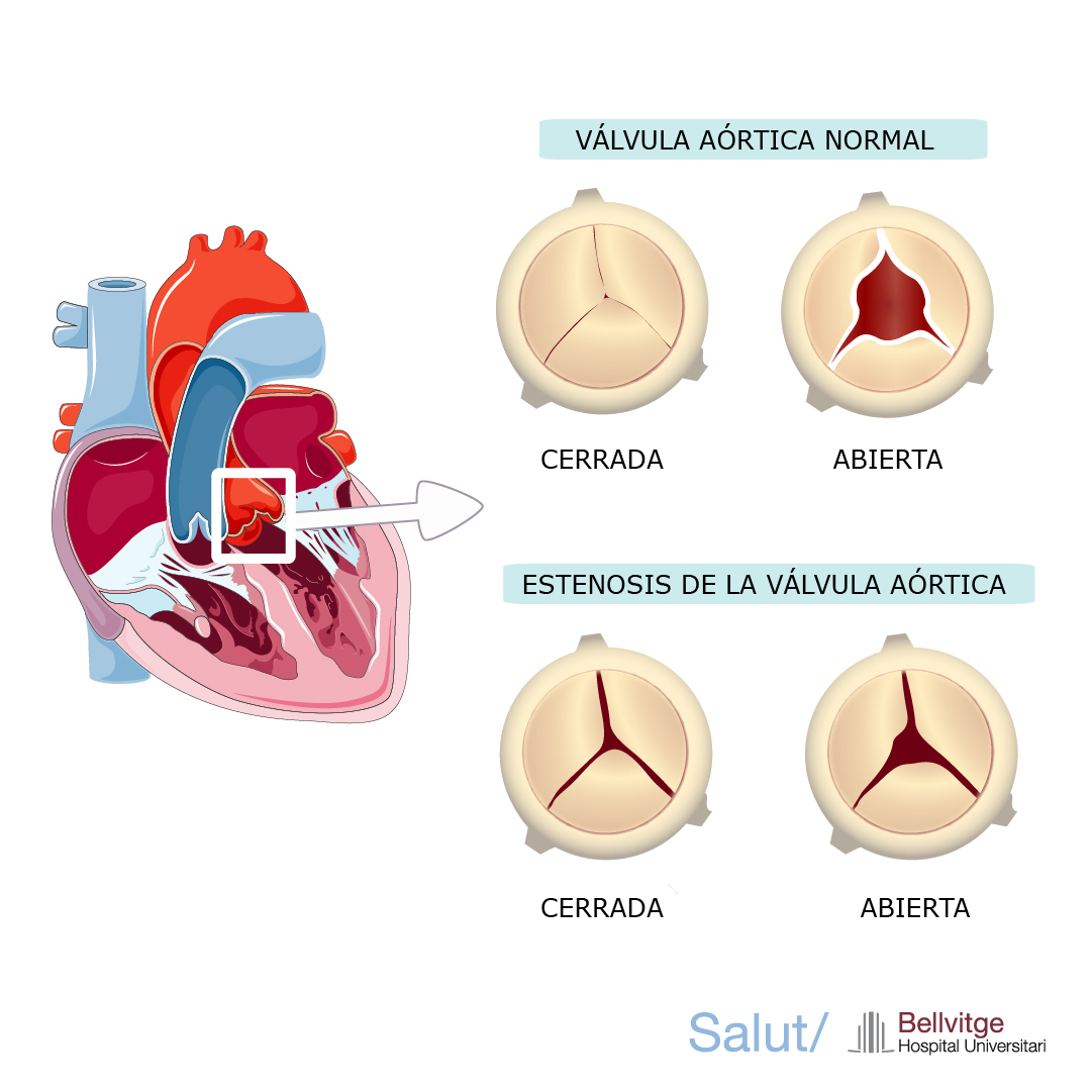 Válvula Aórtica Lo Que Hay Que Saber Hospital De Bellvitge